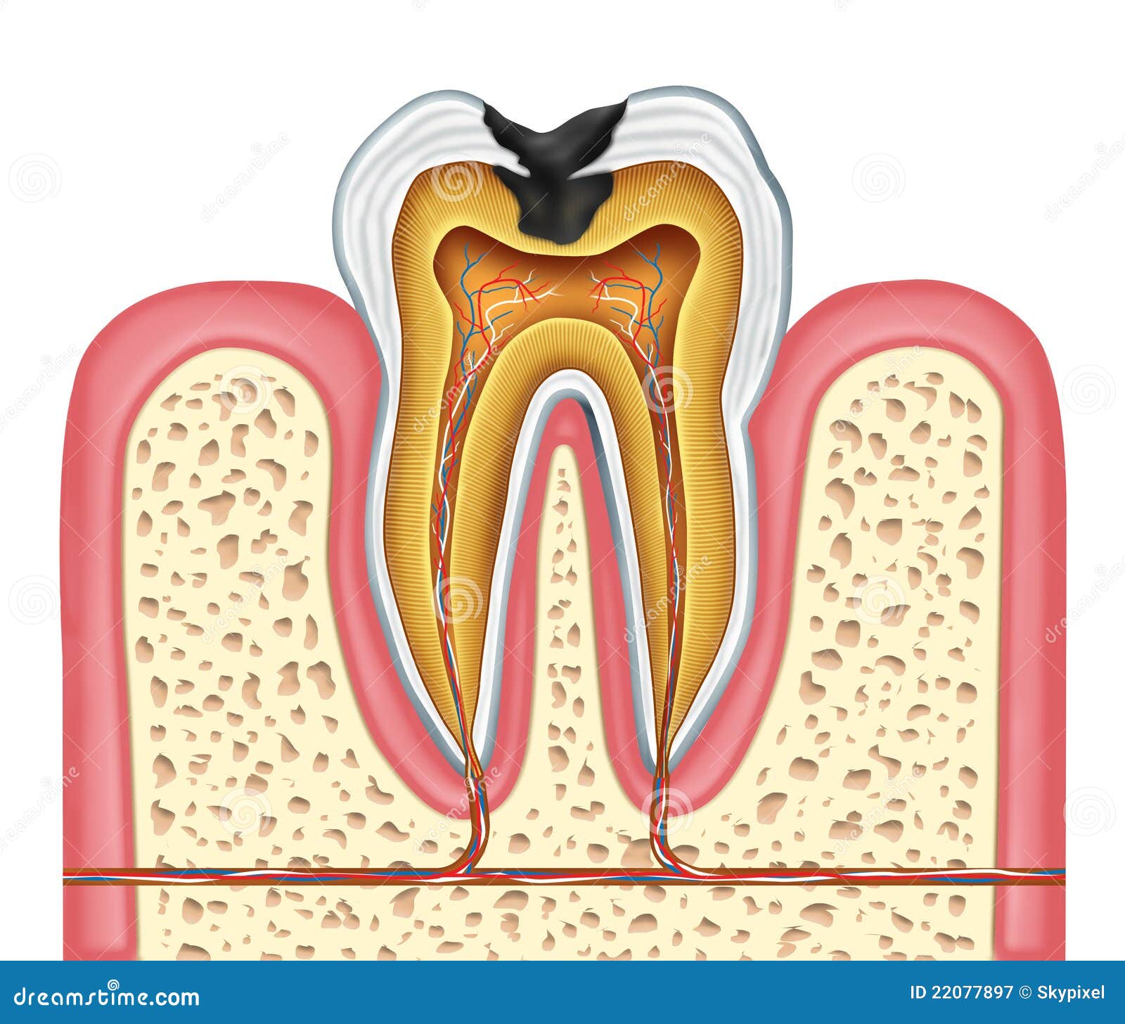 Anatomía Interna Del Diente De Una Cavidad Fotografía de archivo libre ...