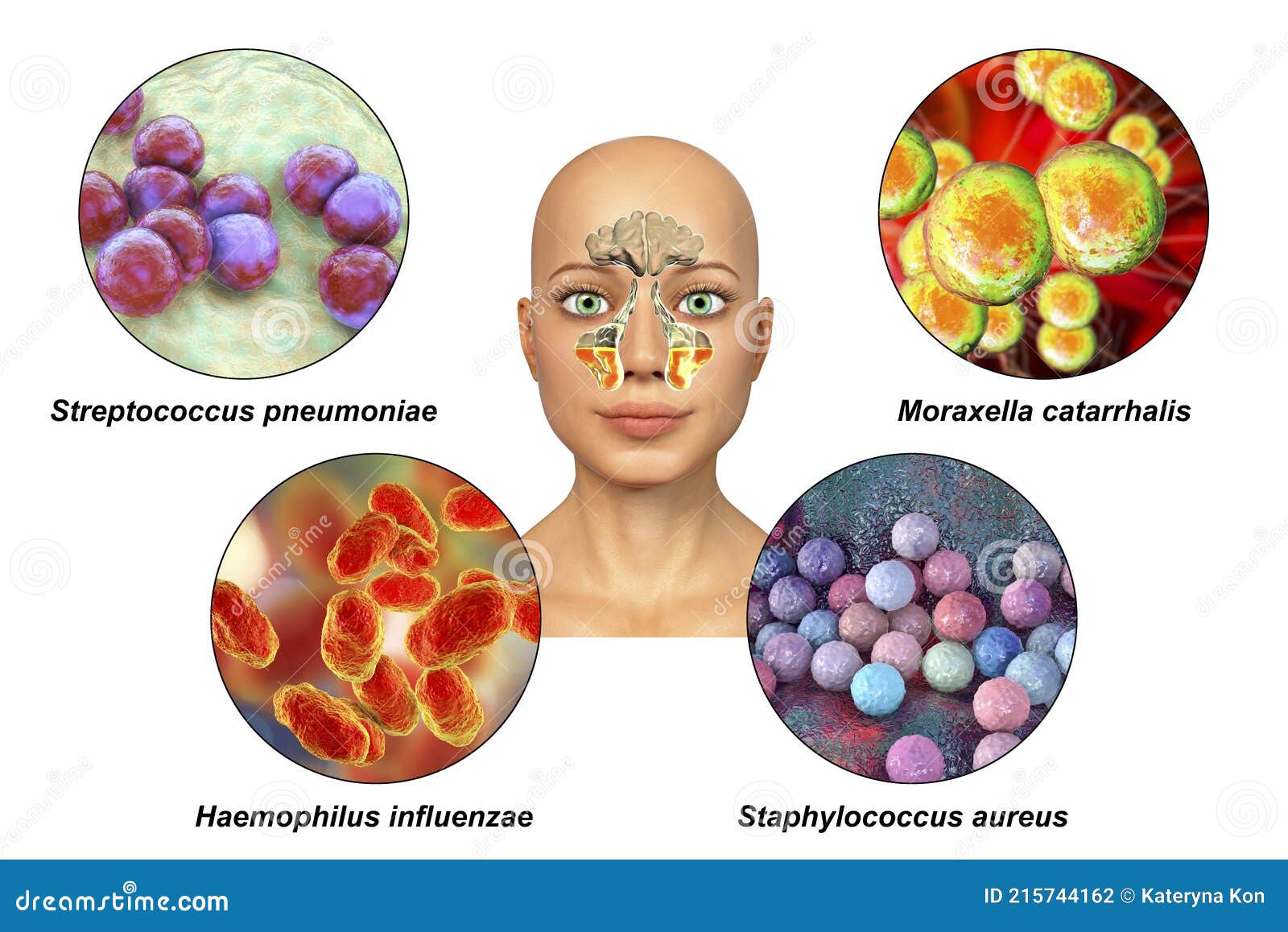 Anatomia Della Rinosinusite E Batteri Che Causano Sinusite ...