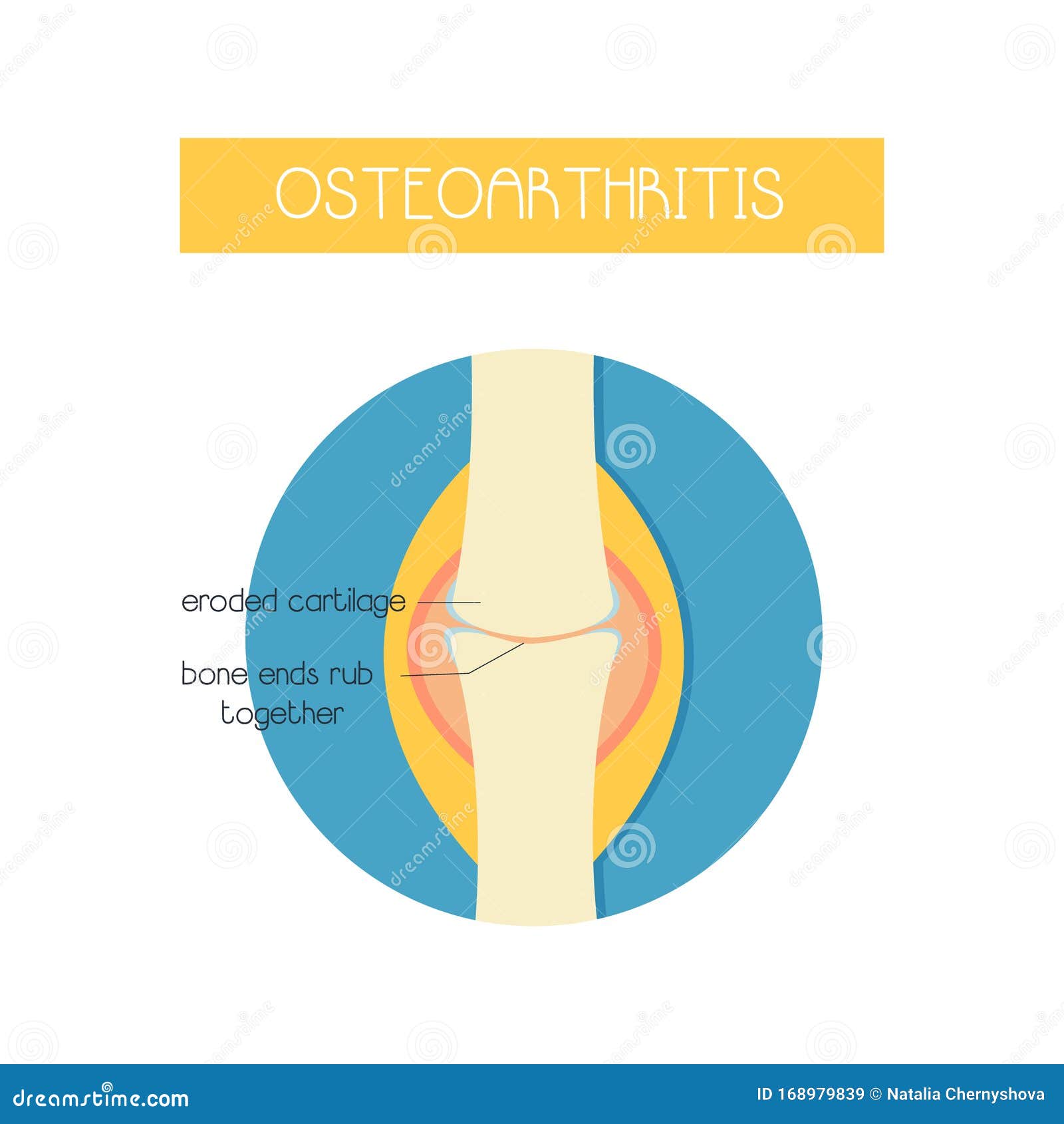 Knee Problem_Quadriceps Tendon Rupture Cartoon Vector | CartoonDealer ...