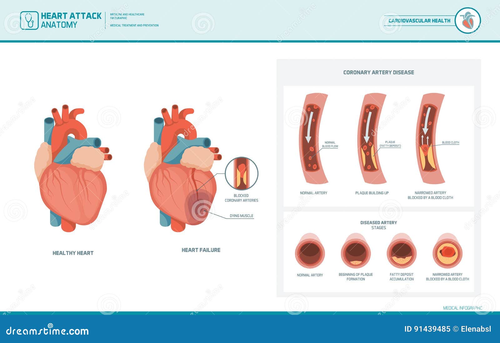 Anatomie D'une Crise Cardiaque Illustration de Vecteur - Illustration ...