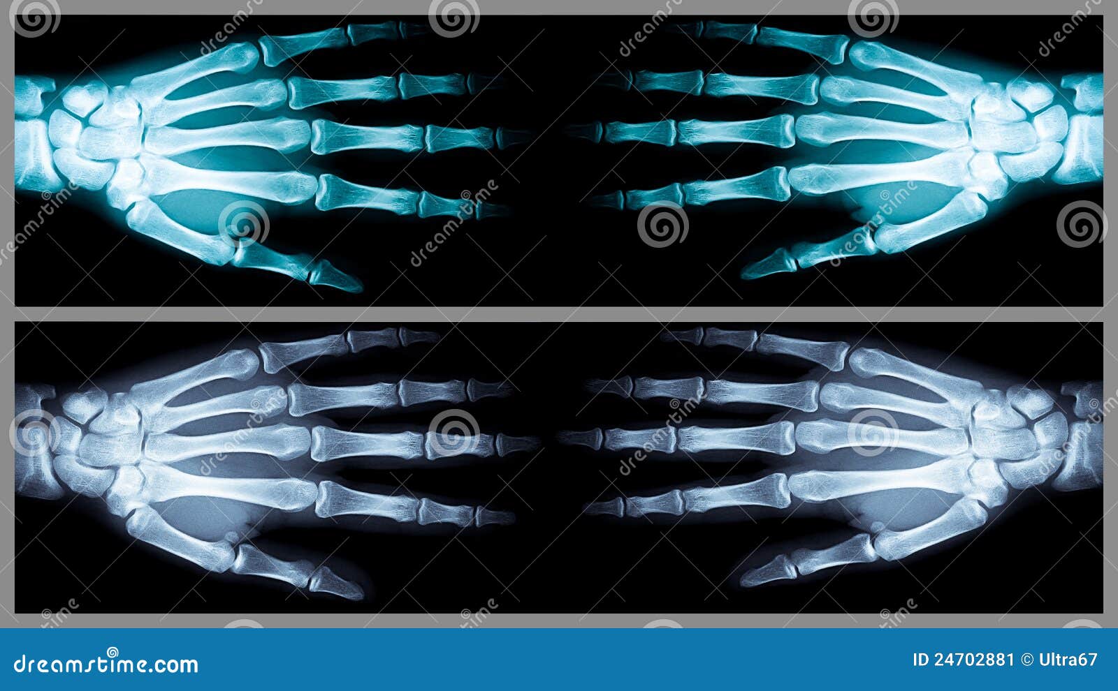 Anatomie de main image stock. Image du axial, commun - 24702881