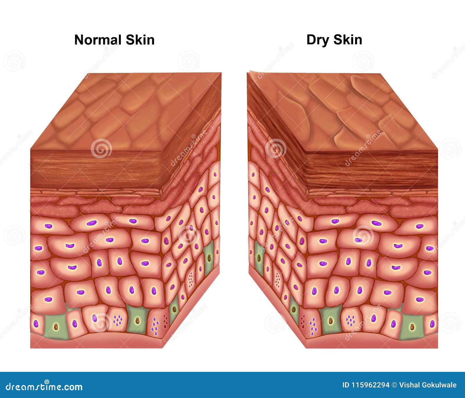 Anatomie de peau sèche illustration stock. Illustration du désordre ...