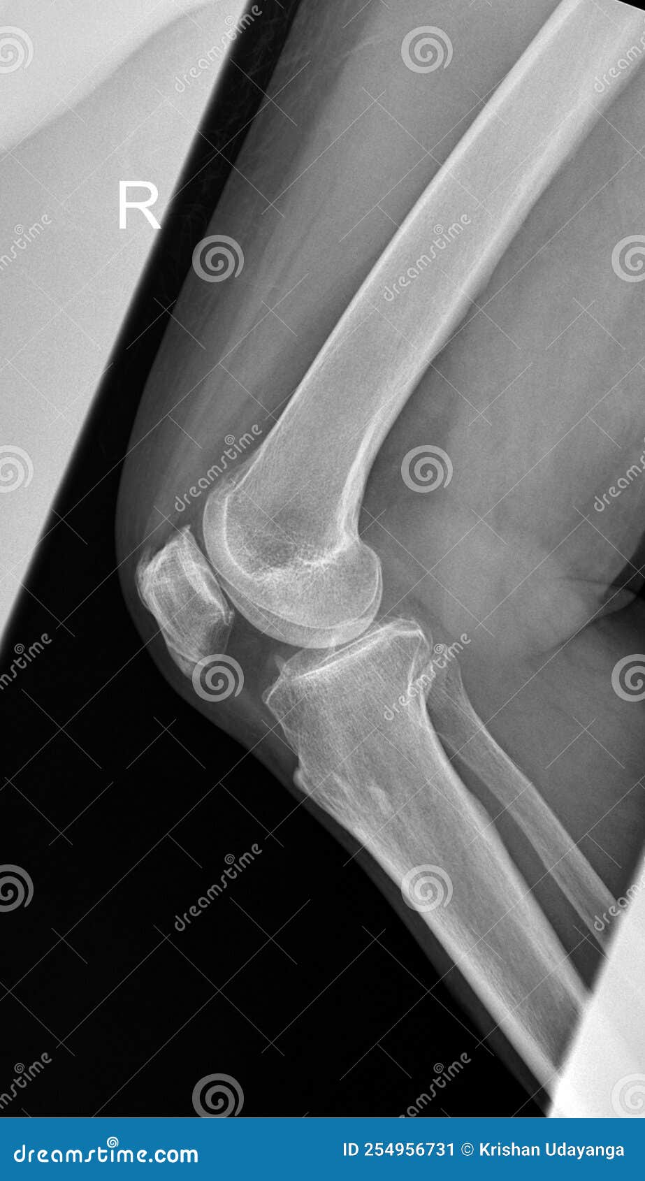 Anatomy of the Knee Joint of Lateral Radiograph Stock Image - Image of ...