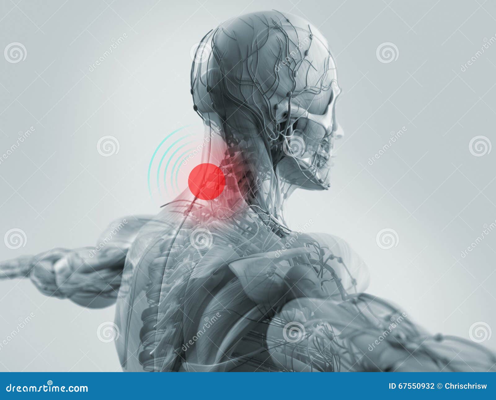Neck Pain Model Stock Illustrations – 99 Neck Pain Model Stock ...