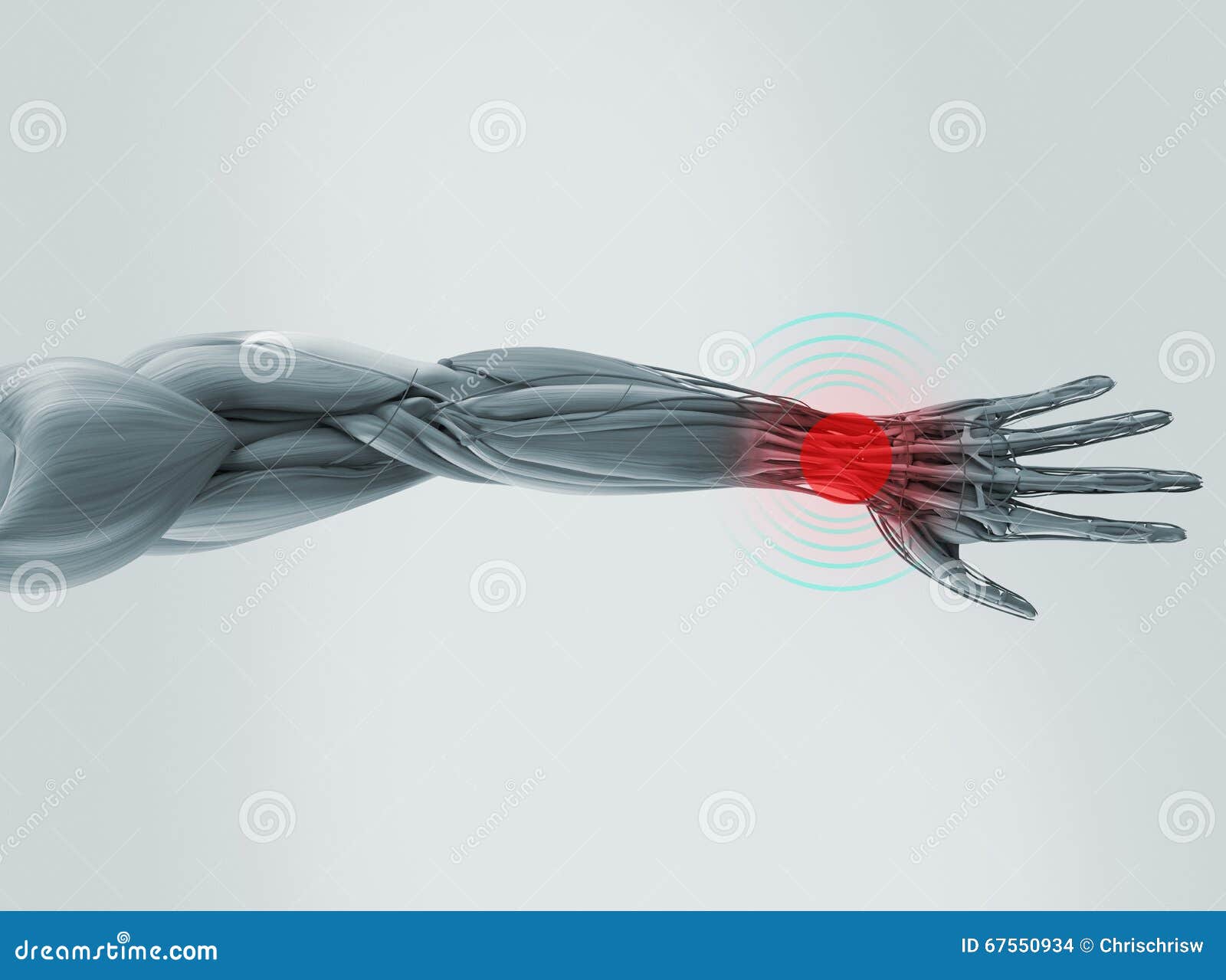 Anatomy Model Showing Wrist Pain. Stock Illustration - Illustration of ...