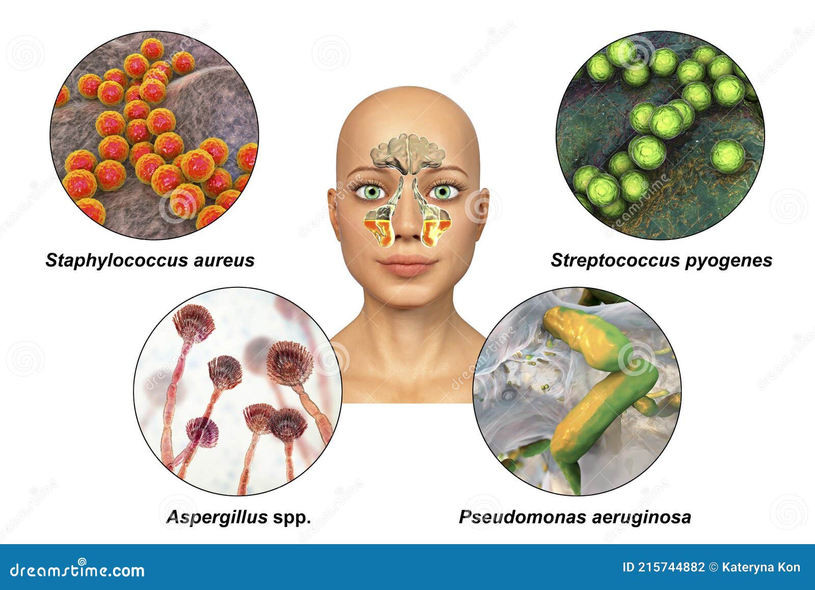 Anatomy of Rhinosinusitis and Microorganisms that Cause Sinusitis Stock ...
