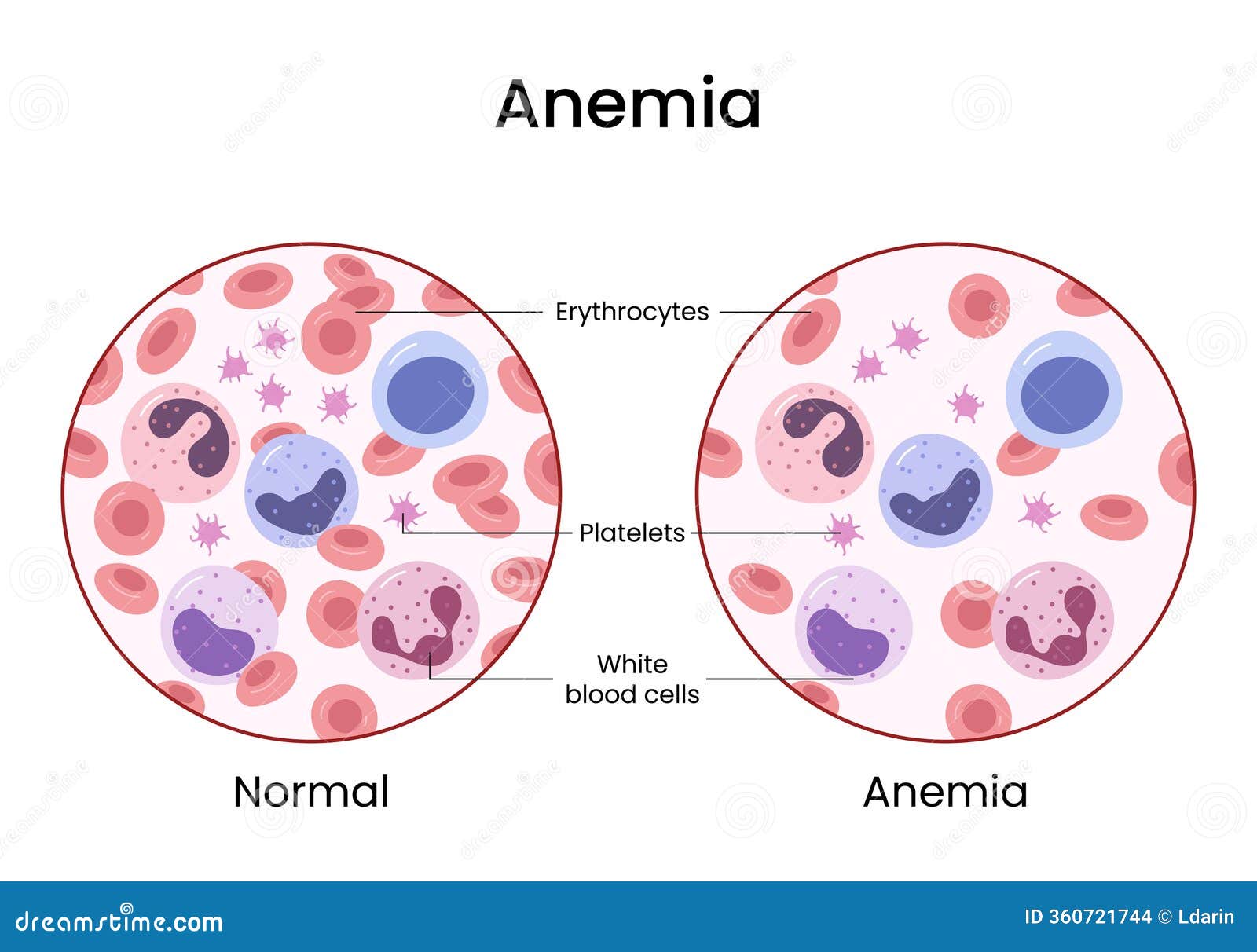 Vector Illustration of the Difference of Number of Healthy Red Blood ...