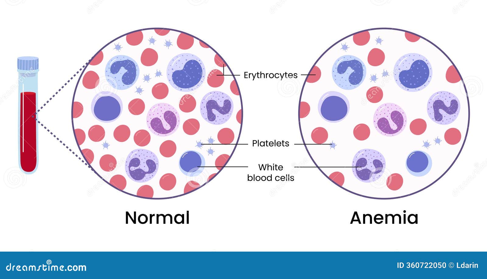 Vector Illustration of the Difference of Number of Healthy Red Blood ...