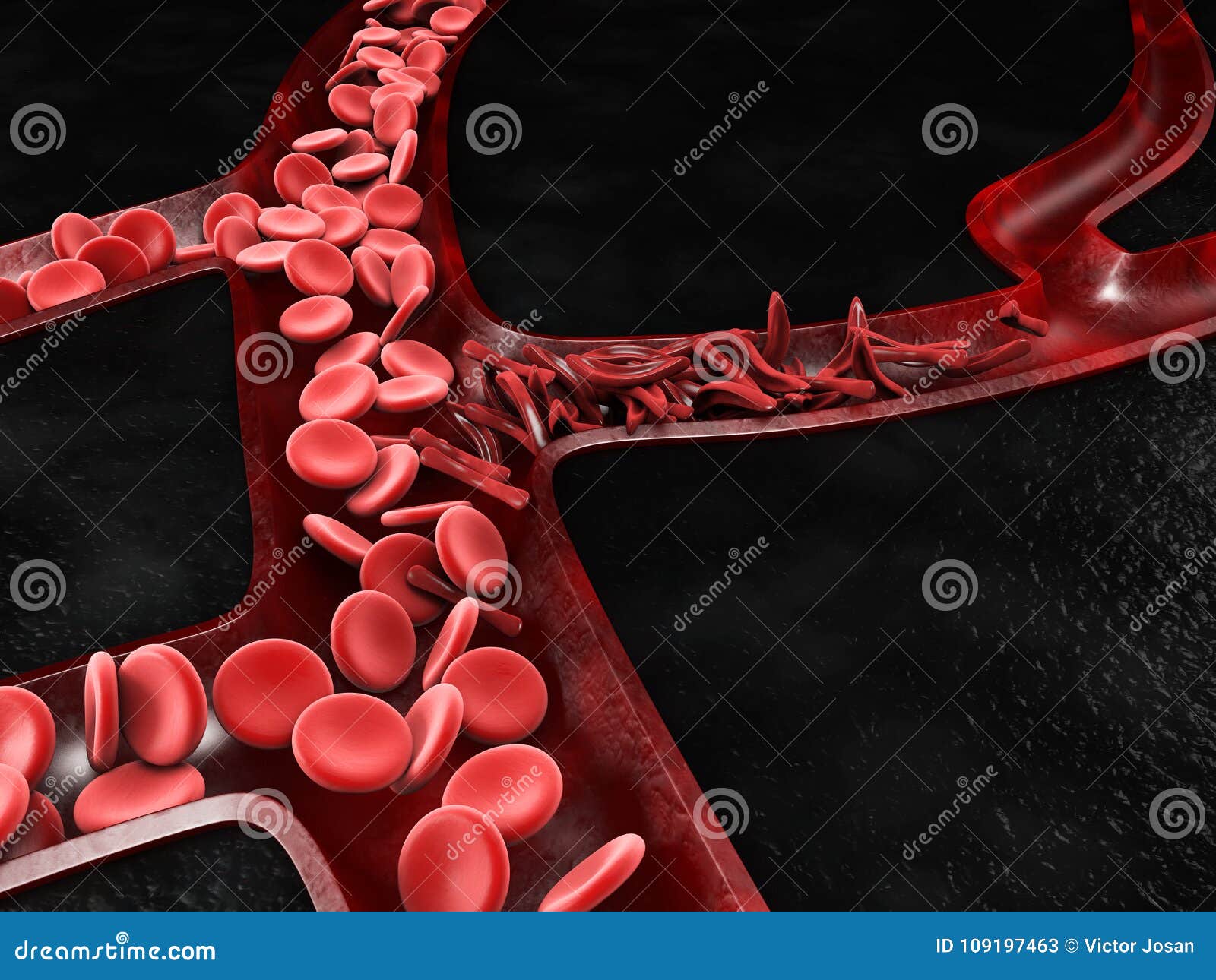 Anemia, Cellula Falciforme E Globulo Rosso Normale, Illustrazione 3d ...