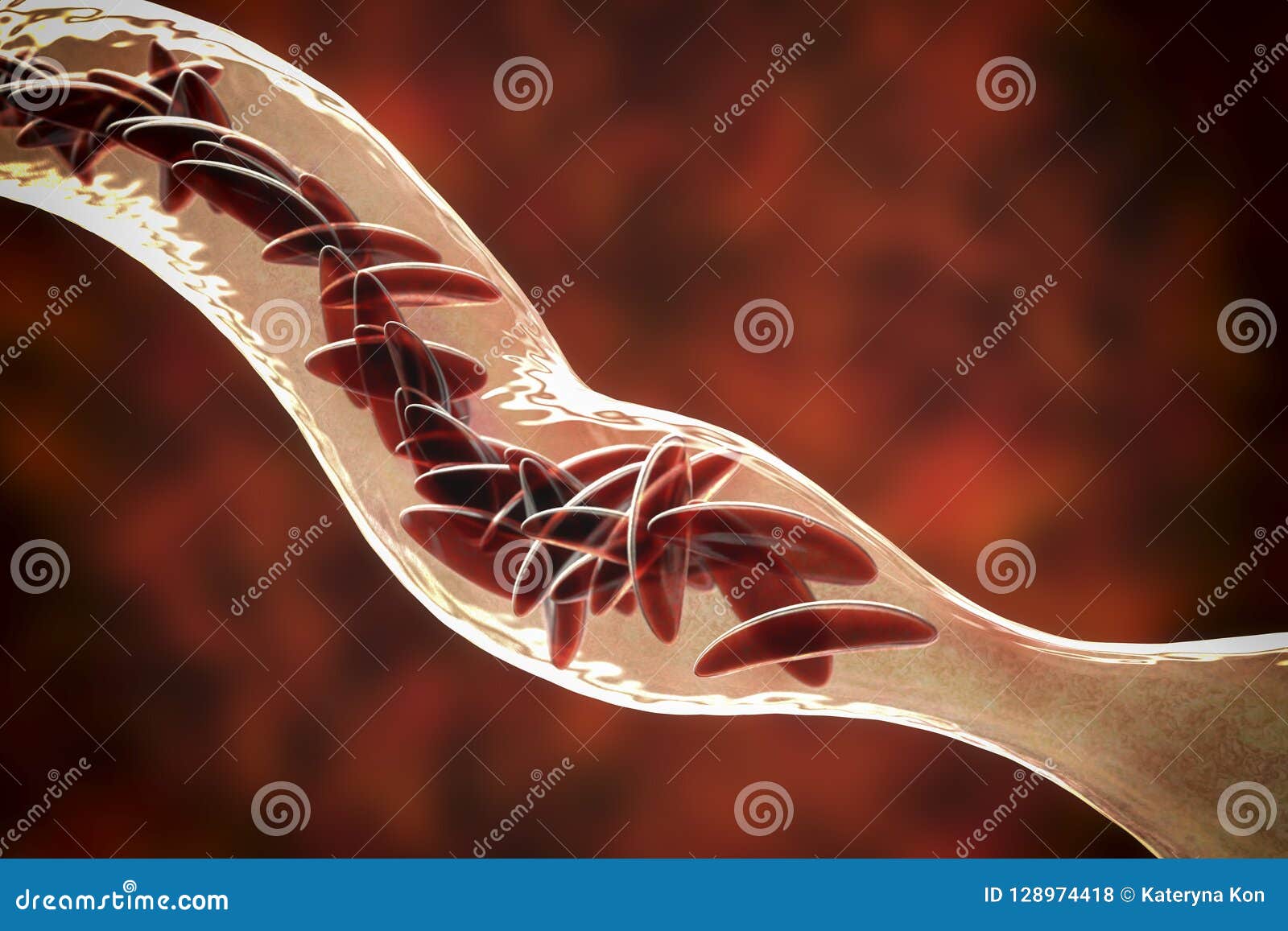 Anemia De La Célula Falciforme Stock de ilustración - Ilustración de ...