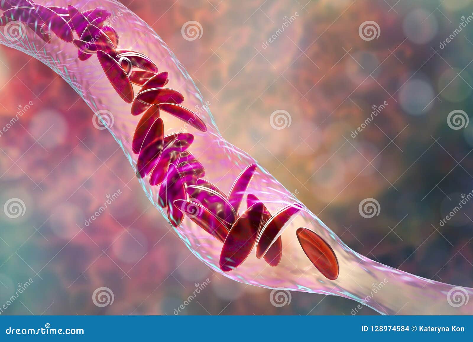 Anemia De La Célula Falciforme Stock de ilustración - Ilustración de ...