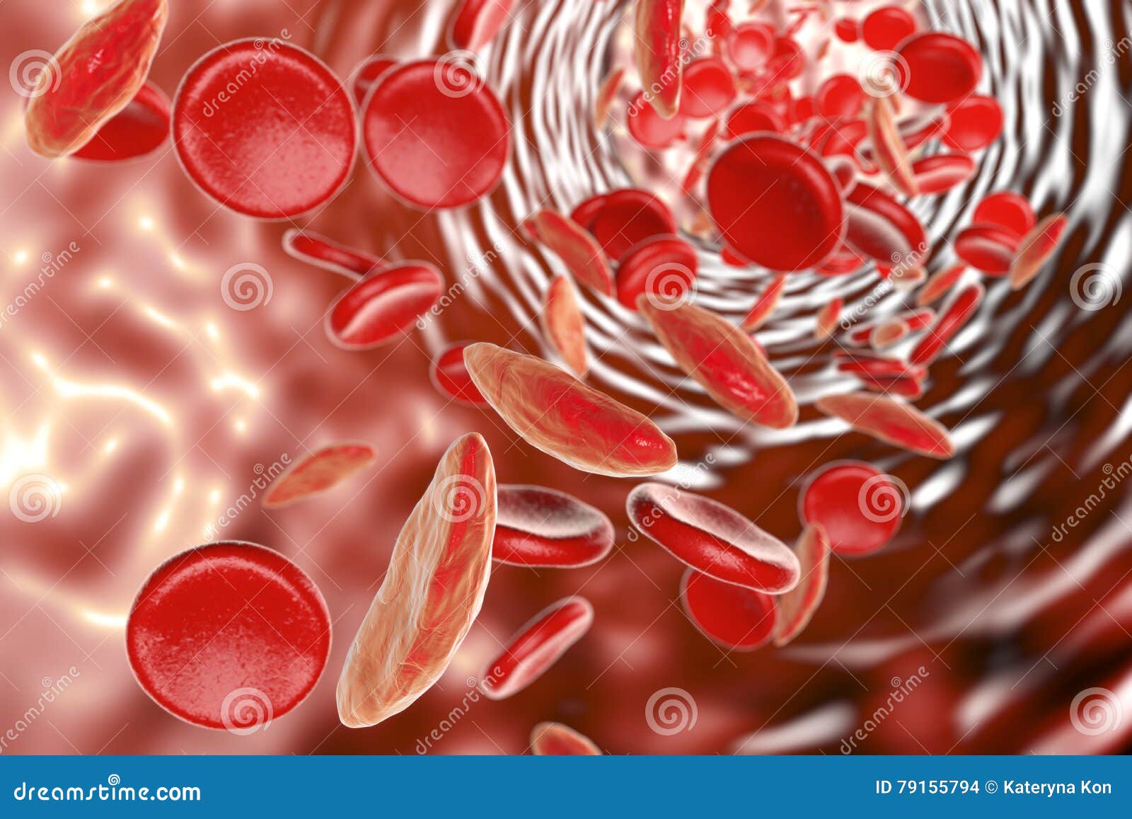 Anemia De La Célula Falciforme Stock de ilustración - Ilustración de ...