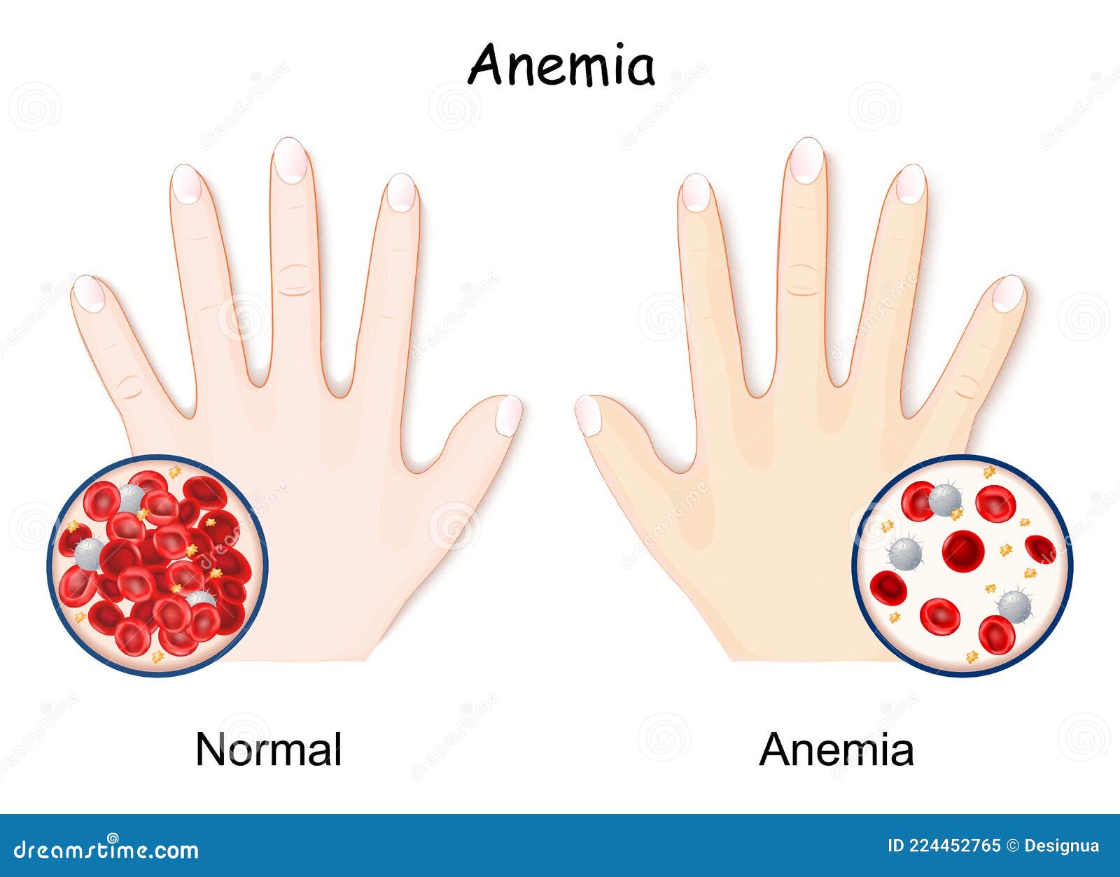 Anemia. Hand of Healthy Human and Anaemia Ilustración del Vector ...