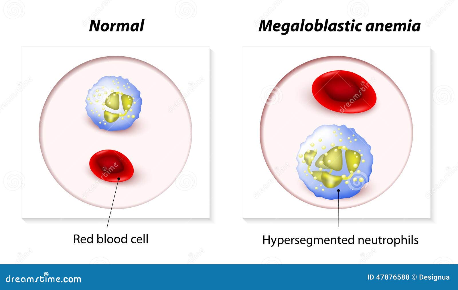 Anemia Megaloblastic ilustração do vetor. Ilustração de biologia - 47876588