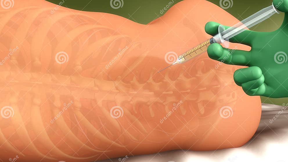 Anesthésie spinale illustration stock. Illustration du anesthésiste ...