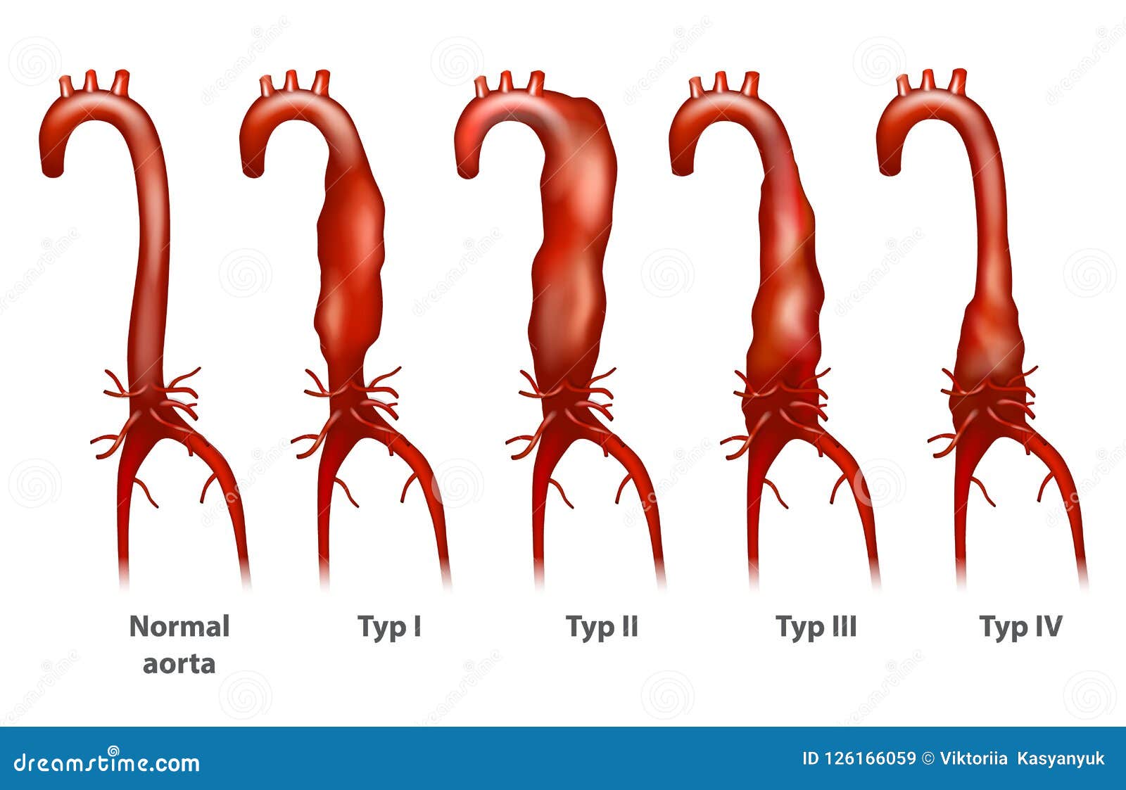 Aneurysm Aortico Addominale Illustrazione Vettoriale - Illustrazione di ...