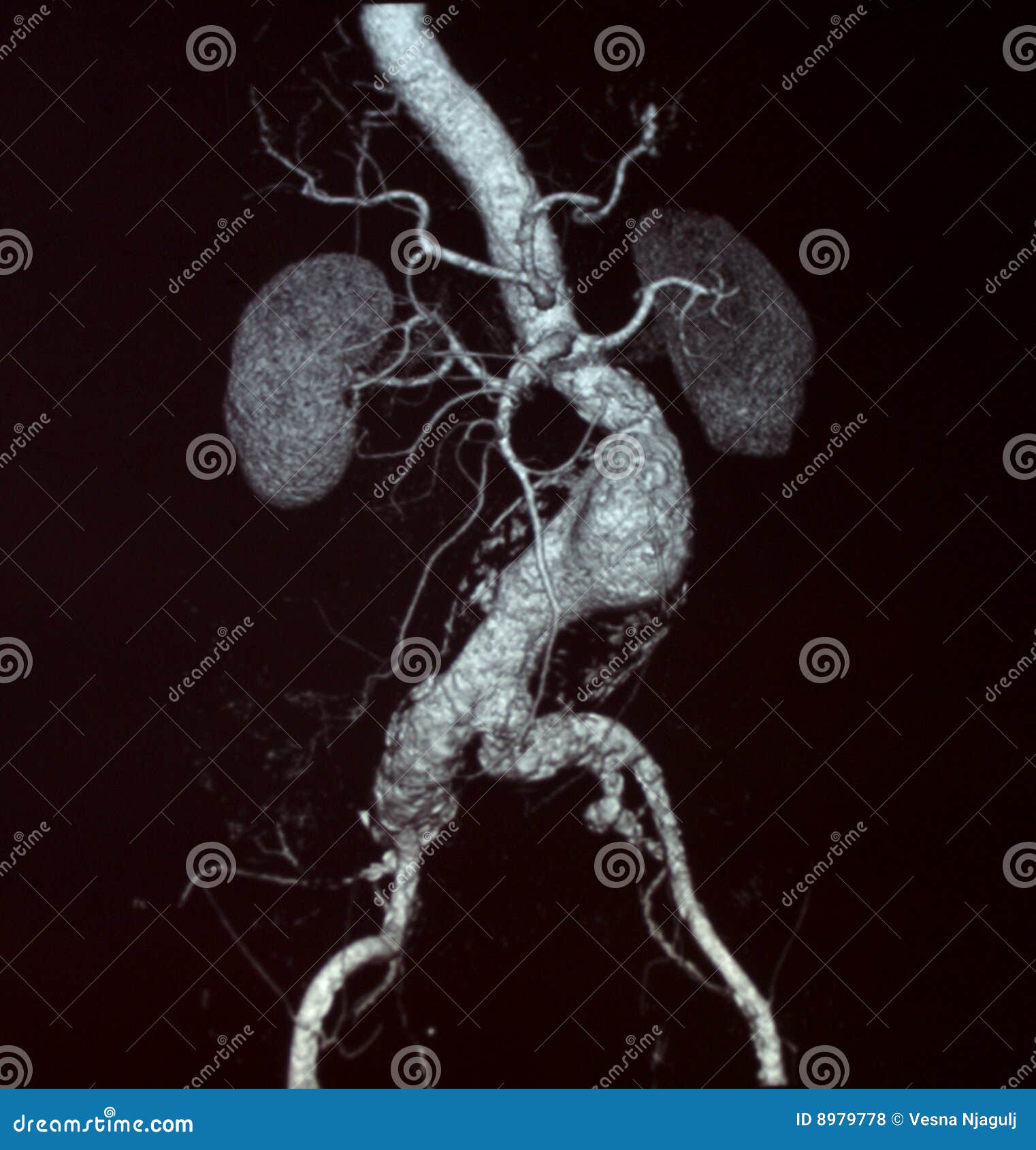 Aneurysm Aortique Abdominal, CT Photo stock - Image du athérosclérose ...