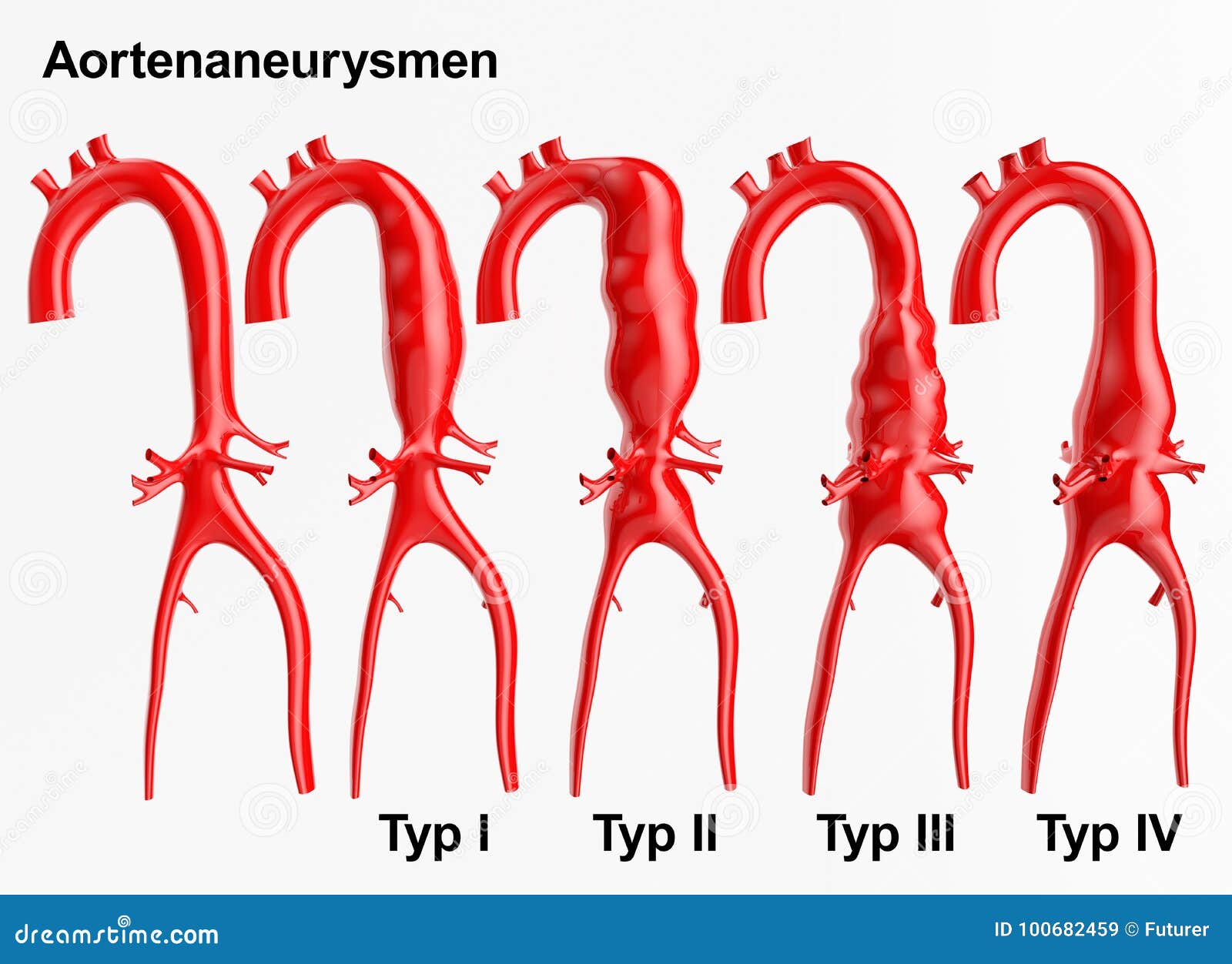 Types Of Aneurysm Cartoon Vector | CartoonDealer.com #74054911