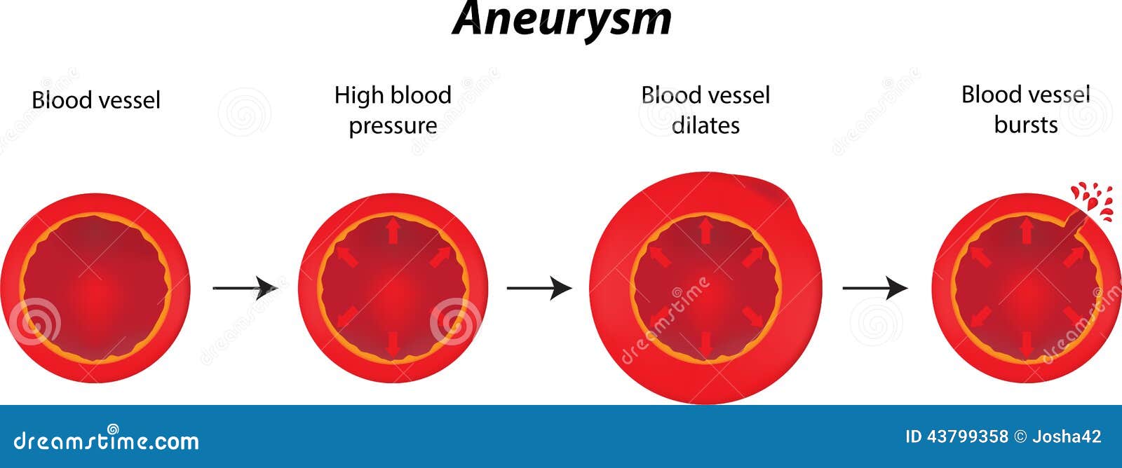 Aneurysm stock vector. Illustration of aneurysm, cardiologist - 43799358