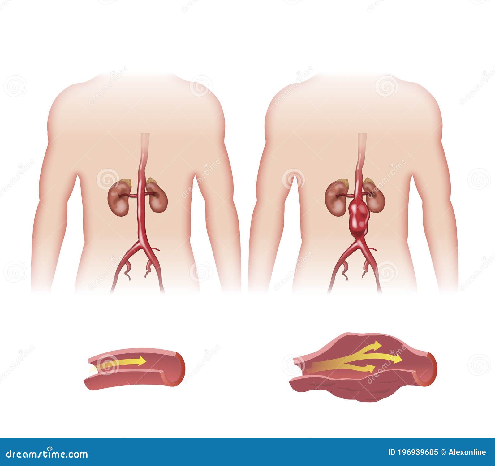 Abdominal Aortic Aneurysm Cartoon Vector | CartoonDealer.com #126166059