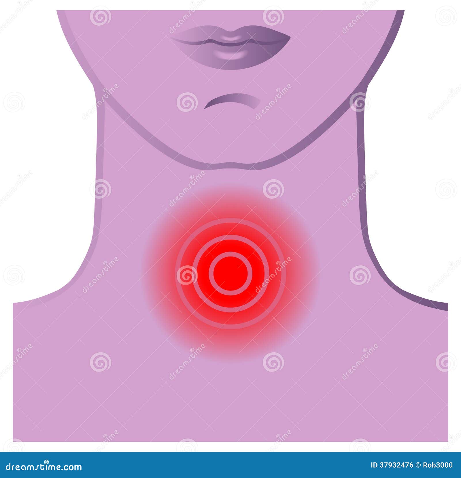 Angine illustration de vecteur. Illustration of infection - 37932476