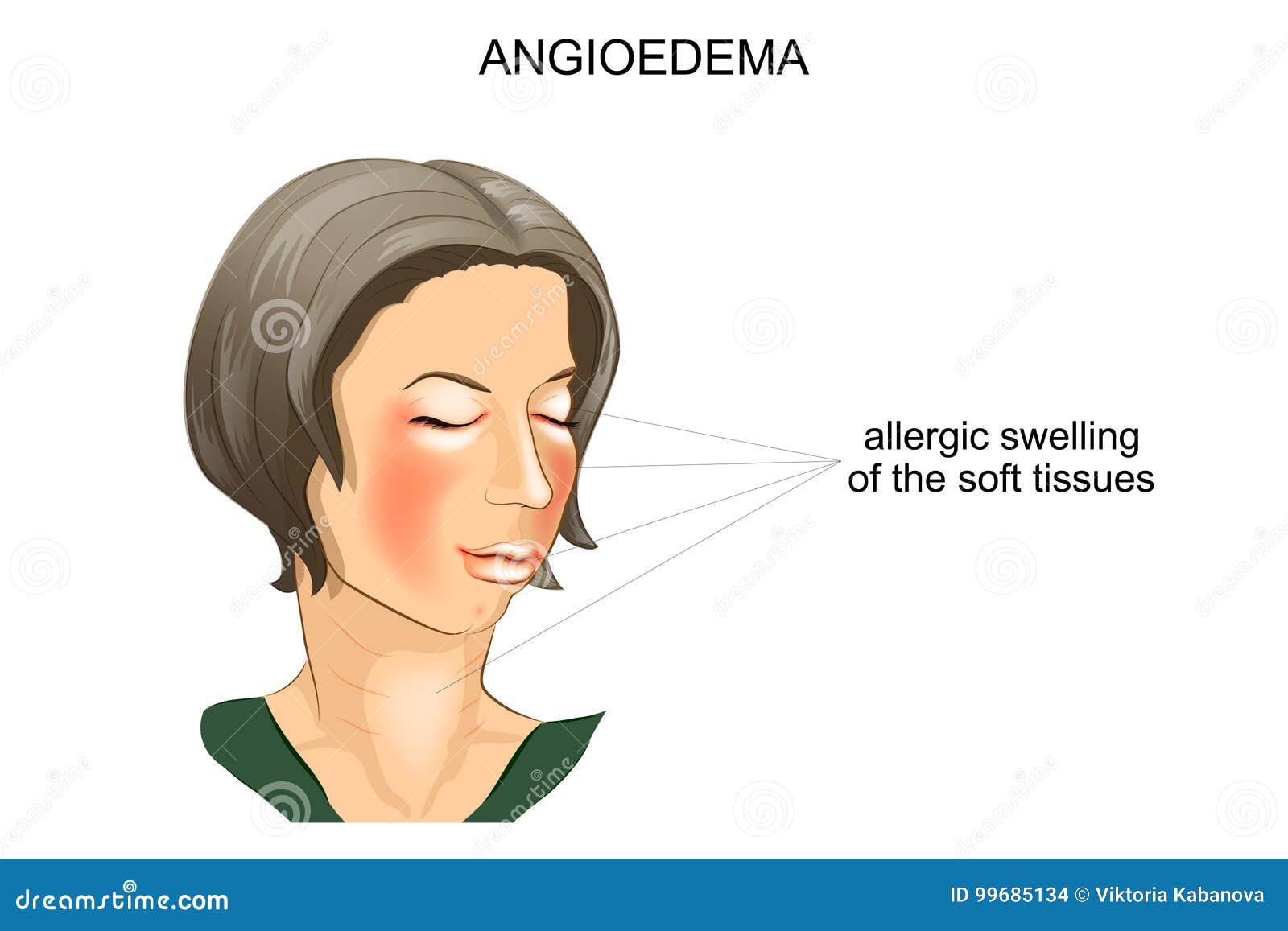 Angioedema. Allergic Swelling Stock Vector - Illustration of medical ...