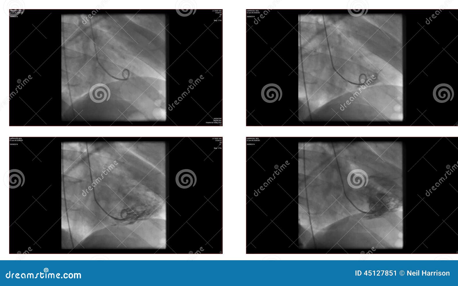 Angiogram Sequence Working Clockwise Using X-rays With A Contrast Agent ...