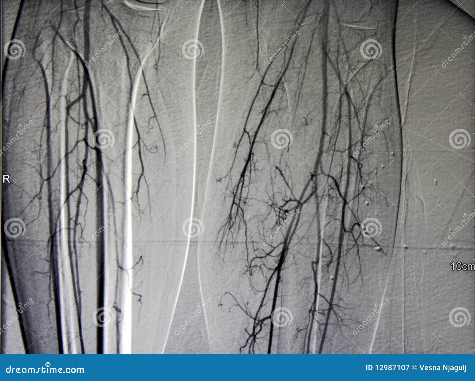 Angiogram of Leg Vessels, Both Calf Stock Image - Image of life, study ...