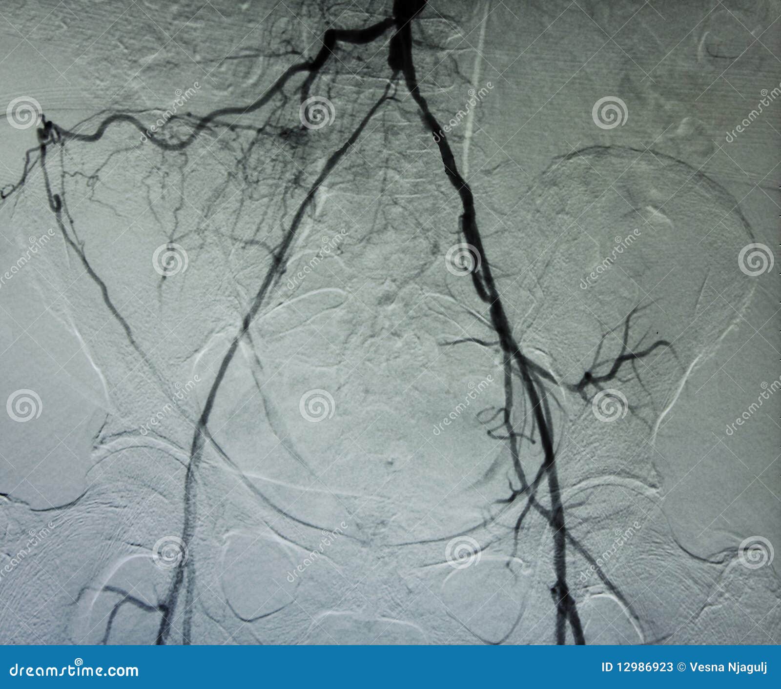 Angiogram of Pelvic Vessels Stock Image - Image of radiography, health ...