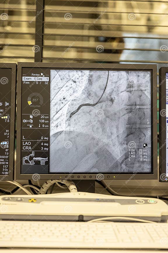 Angiogram Sequence Working Clockwise Using X-rays with a Contrast Agent ...