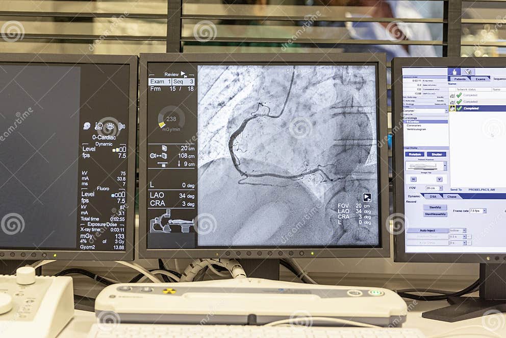 Angiogram Sequence Working Clockwise Using X-rays with a Contrast Agent ...
