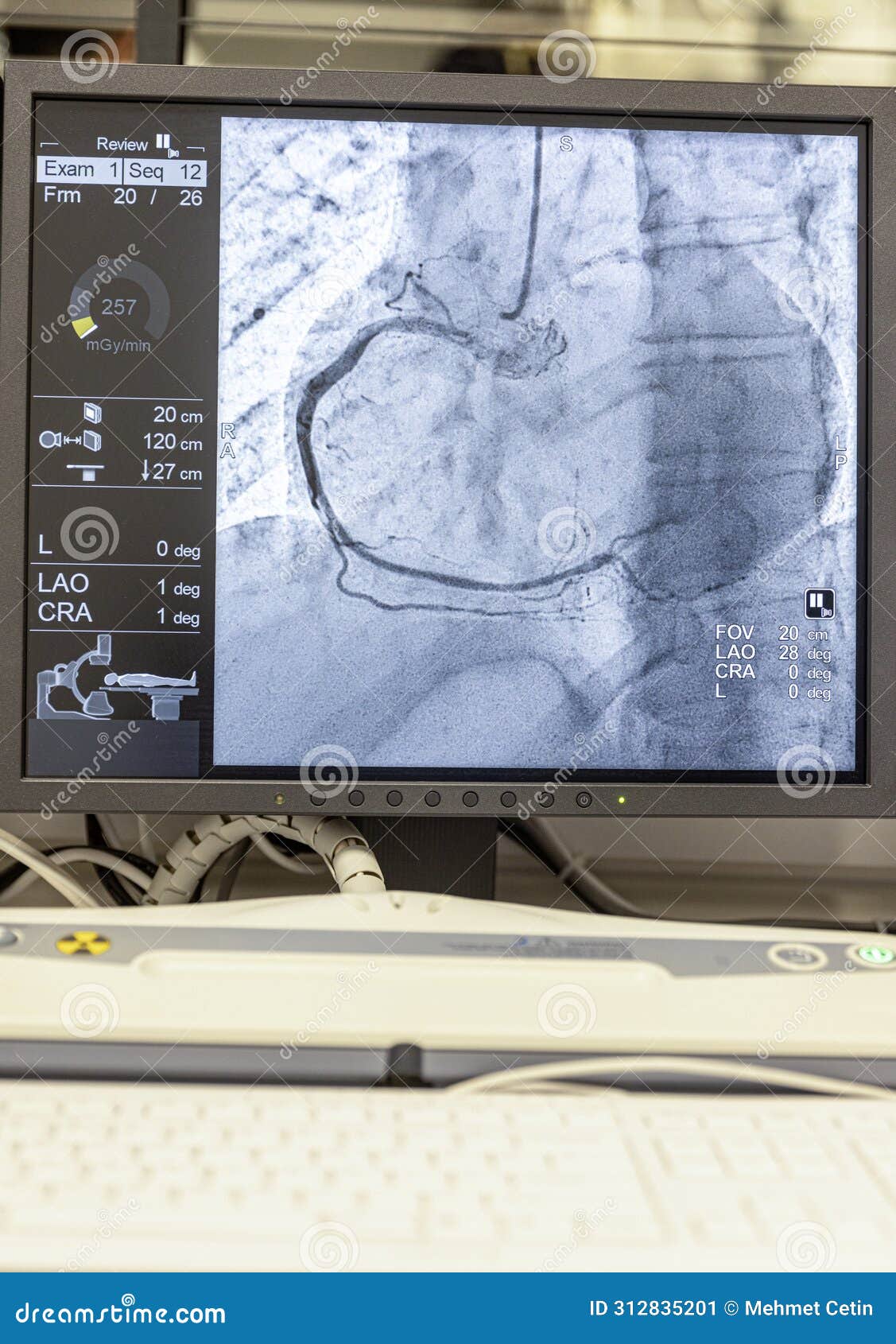 Angiogram Sequence Working Clockwise Using X-rays with a Contrast Agent ...