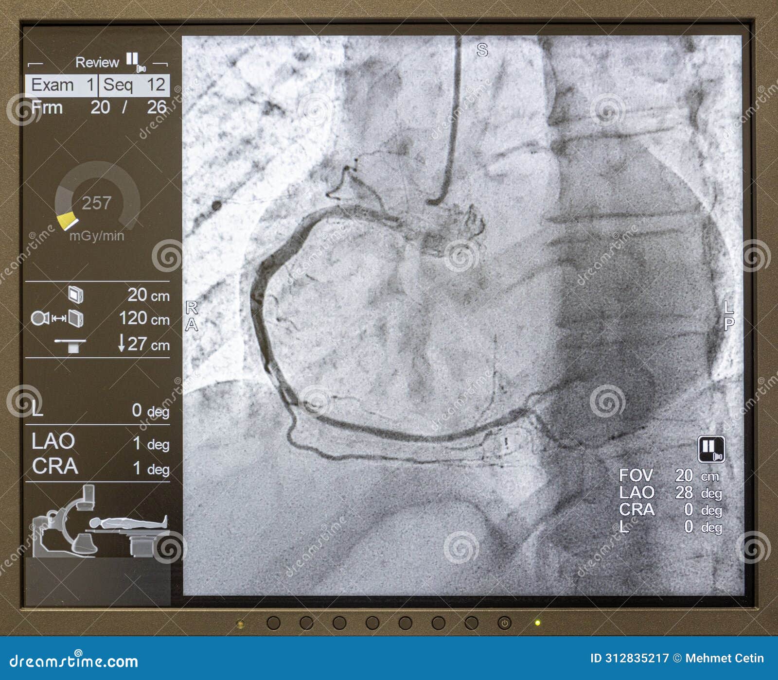Angiogram Sequence Working Clockwise Using X-rays with a Contrast Agent ...