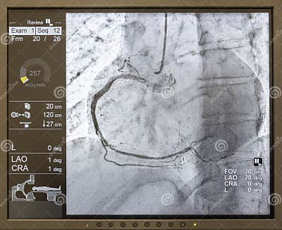 Angiogram Sequence Working Clockwise Using X-rays with a Contrast Agent ...