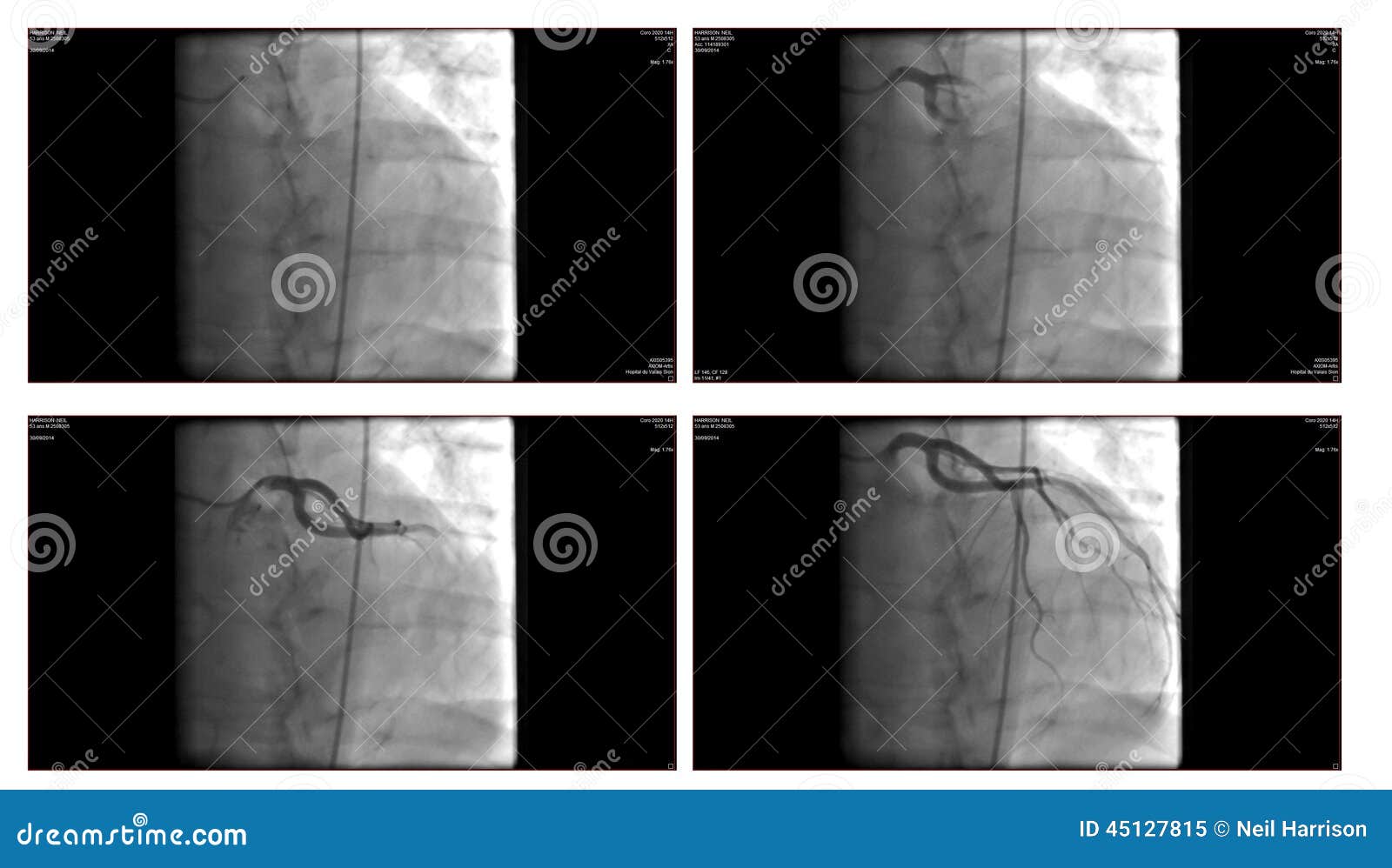 Angiogram stock image. Image of aorta, blood, arteriogram - 45127815