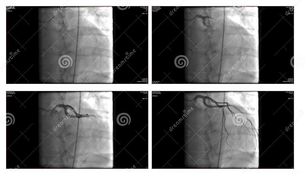 Angiogram stock image. Image of aorta, blood, arteriogram - 45127815