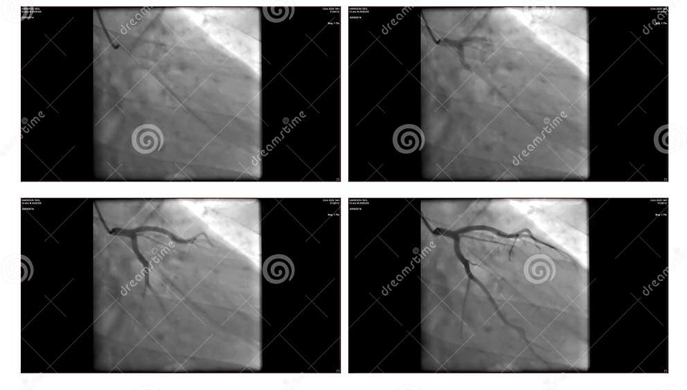Angiogram stock image. Image of doctors, aorta, bleed - 45127817