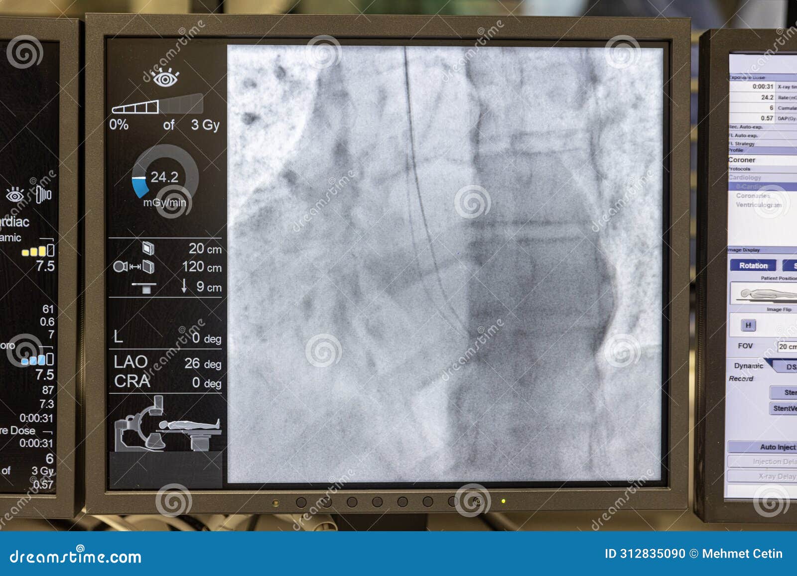 Angiogram Sequence Working Clockwise Using X-rays With A Contrast Agent ...