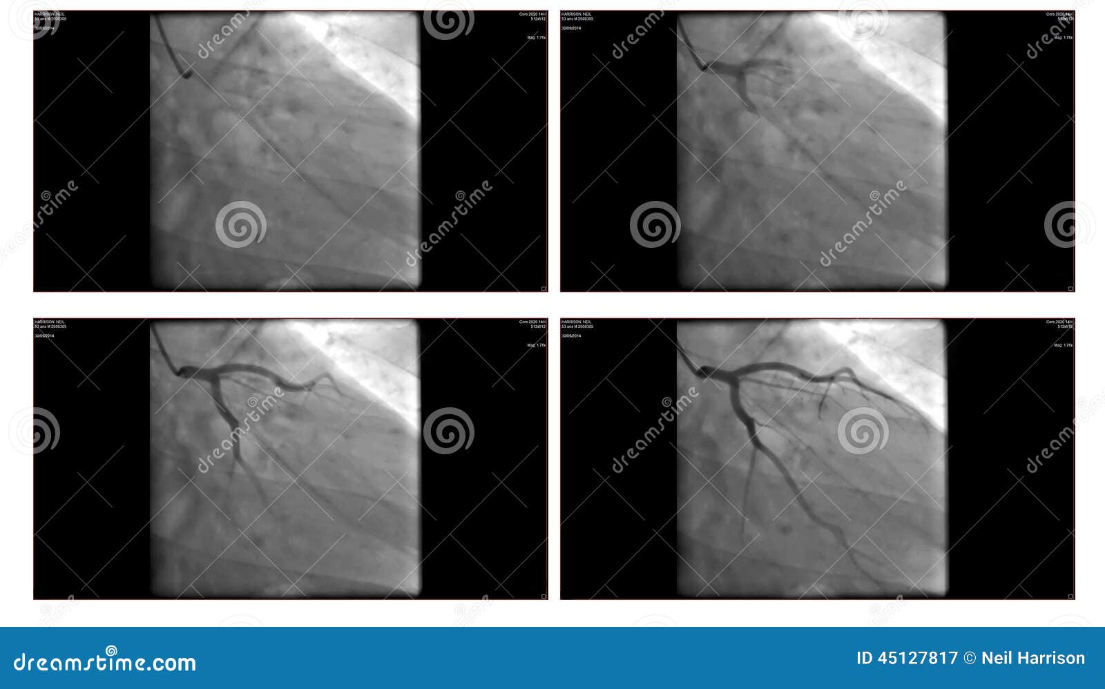 Angiogram Of Right Common Iliac Artery After Aortic Stent Graft ...