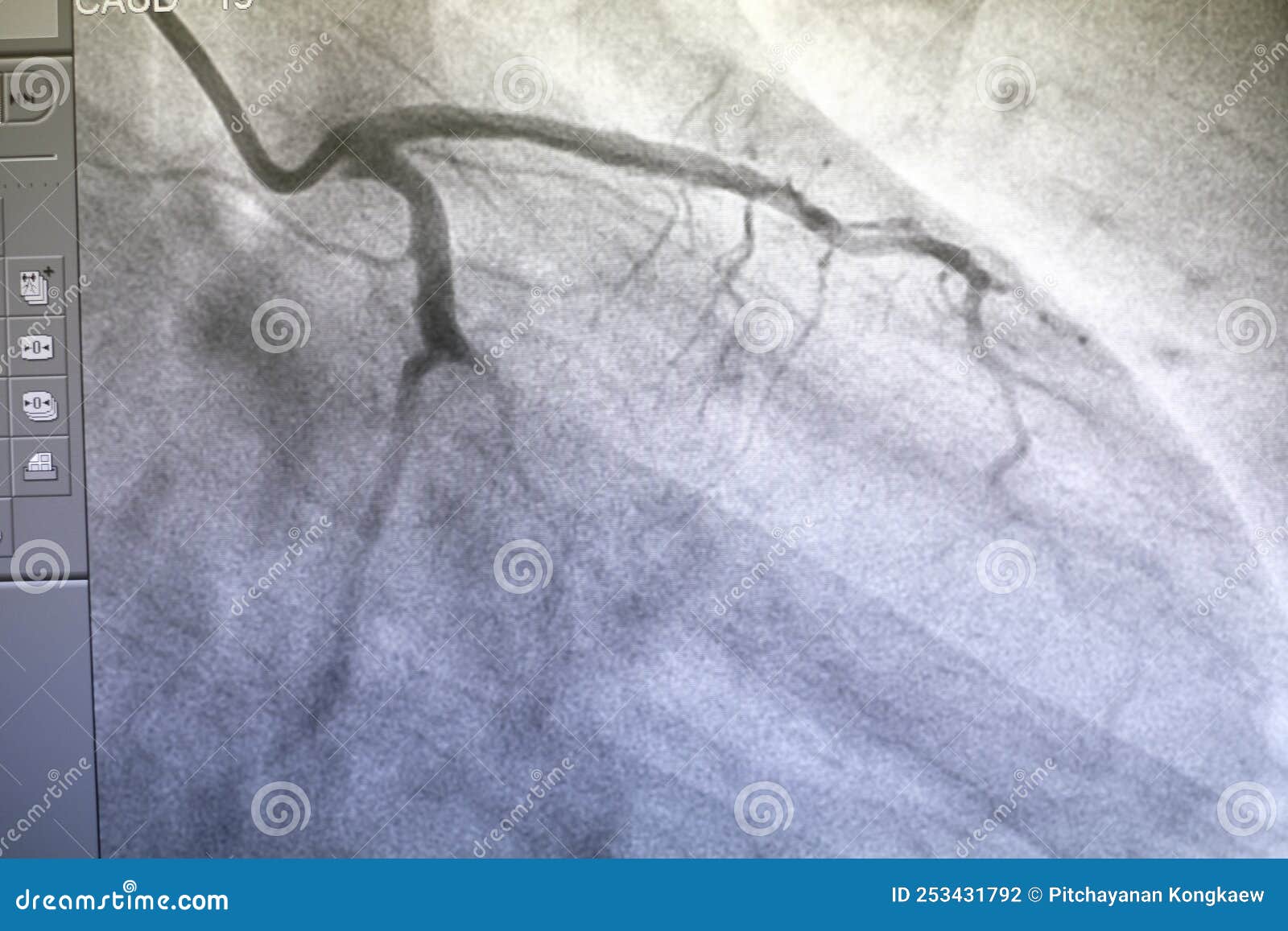 Angiograma coronario foto de archivo. Imagen de miocardio - 253431792