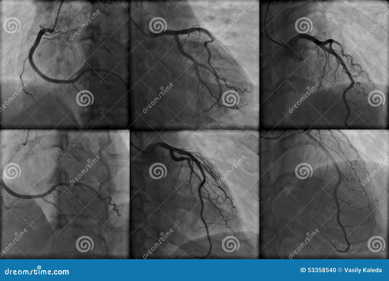 Angiographie coronaire photo stock. Image du gauche, diagnostique ...