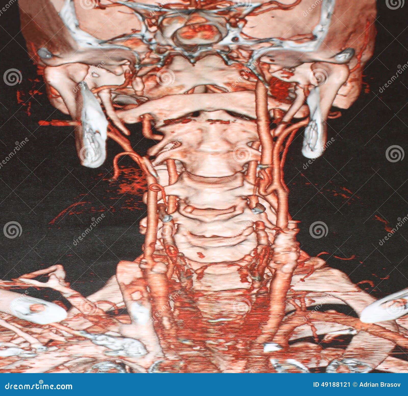 Angiographie CT image stock. Image du sang, recherche - 49188121