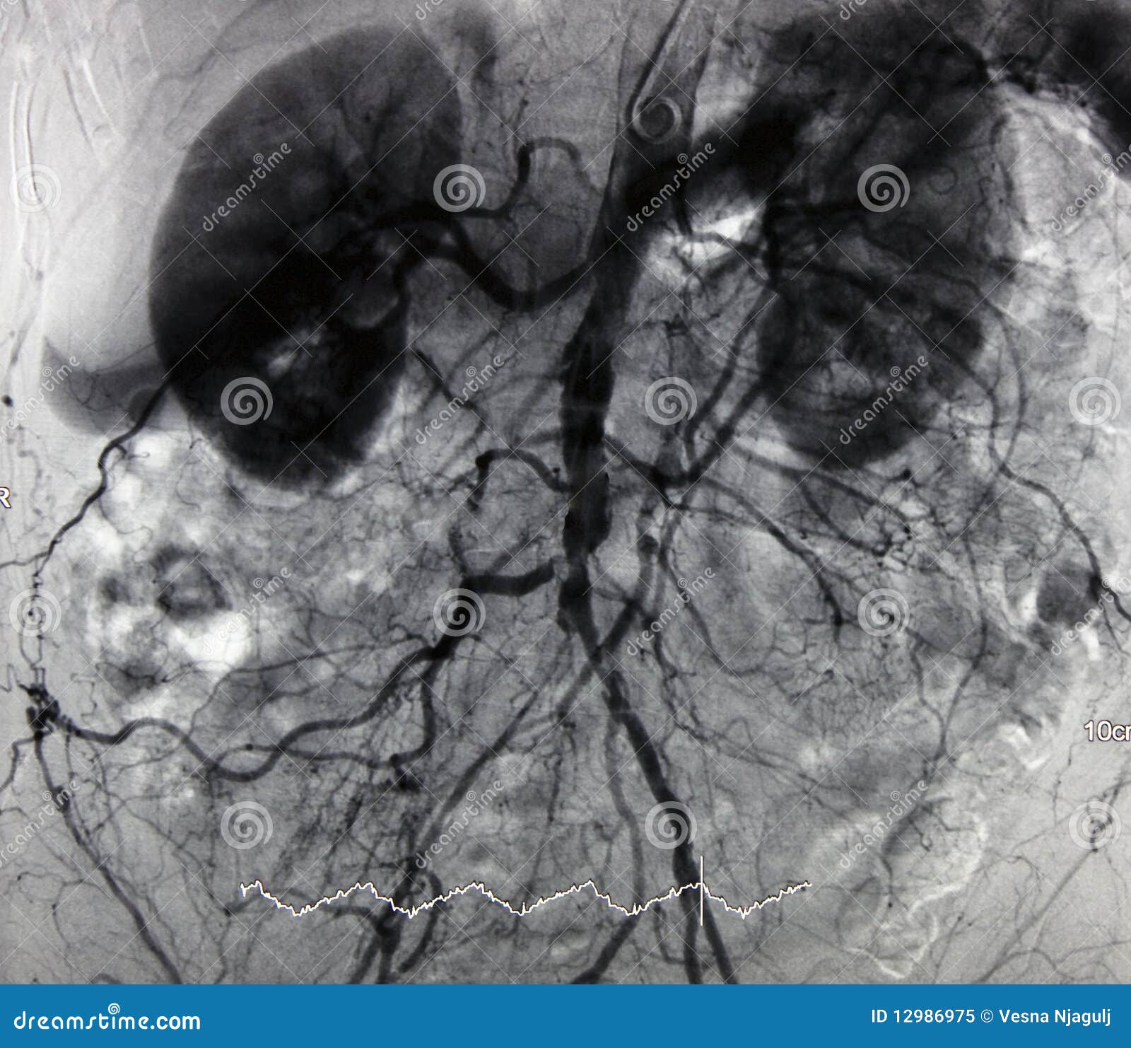 Anatomy Of Aorta And Vena Cava On A White Background Stock Image ...