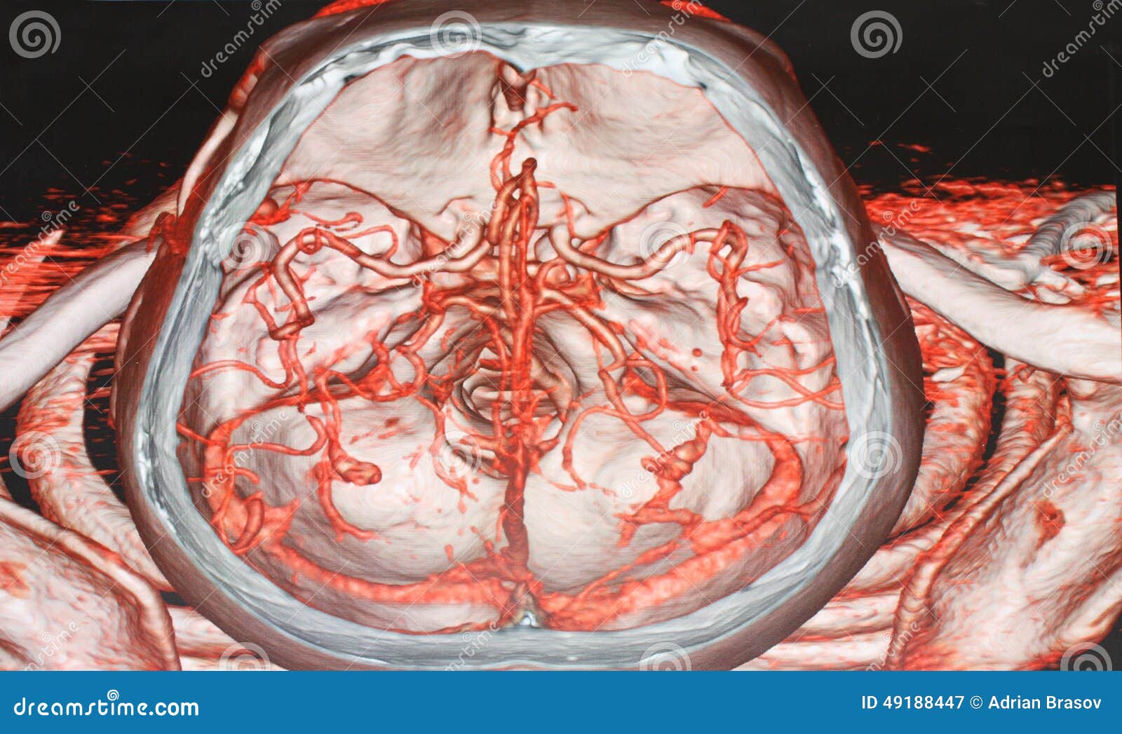 CT Angiography (Computed Tomography Angiography: CTA) Of Abdominal ...
