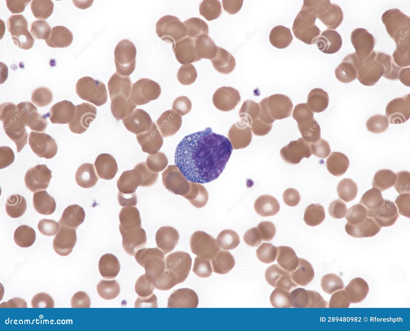 Angioimmunoblastic T-cell Lymphoma. Stock Illustration - Illustration ...