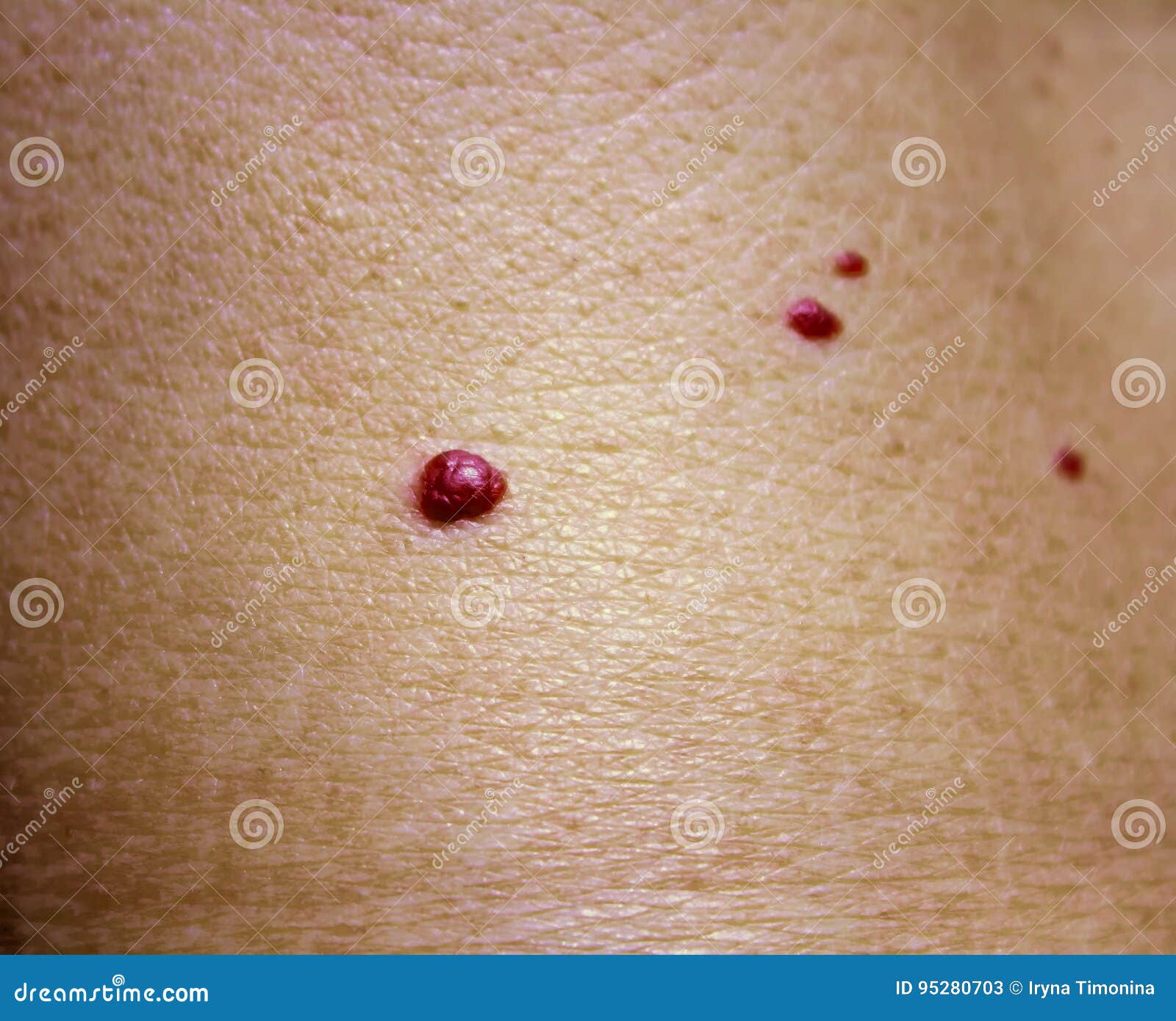 Angioma. Red Birthmark on the Skin Surface Stock Image - Image of nevus ...
