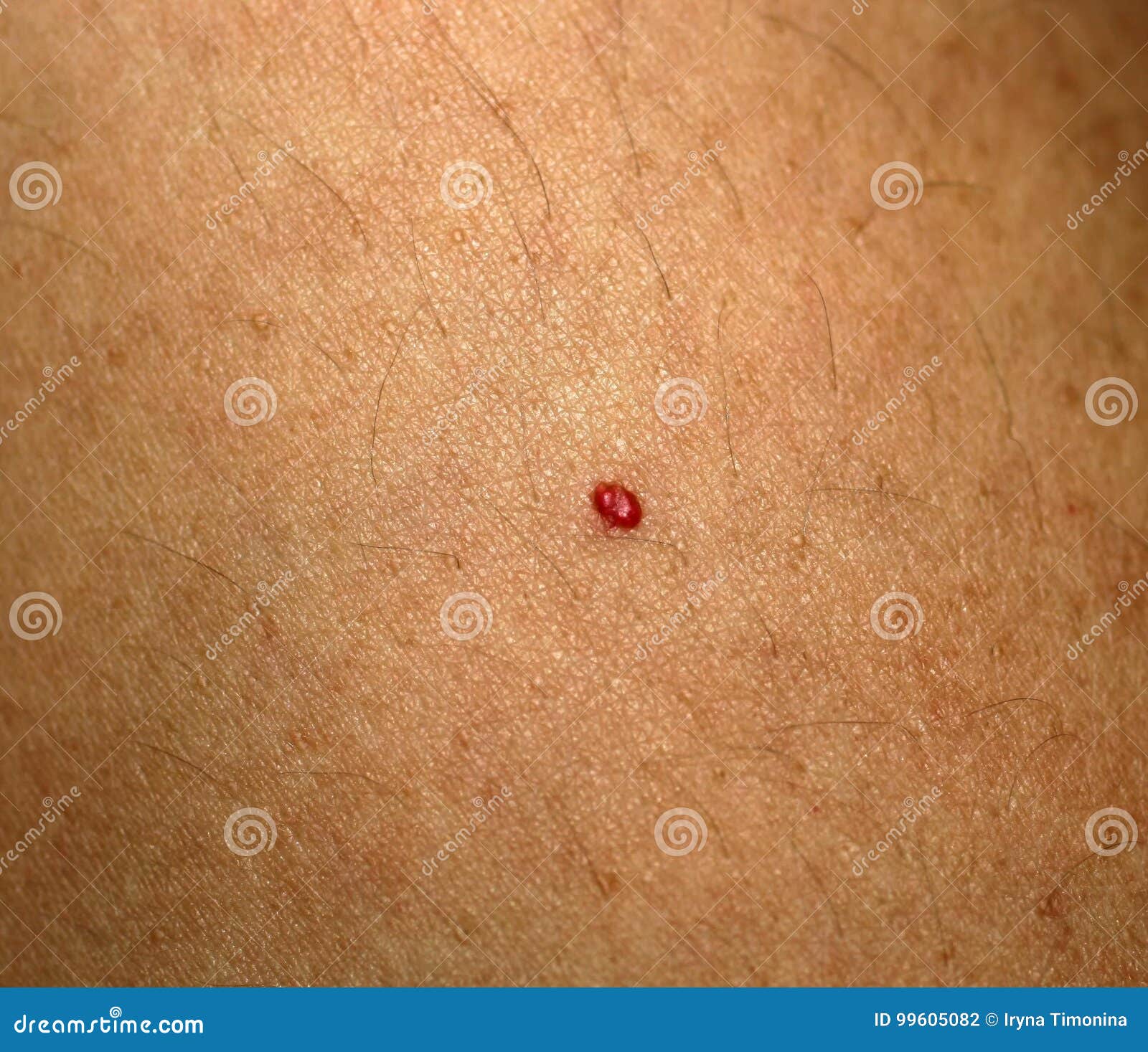 Angioma Rode Mol Op Het Lichaam Moedervlek Op Huid Stock Foto - Image ...