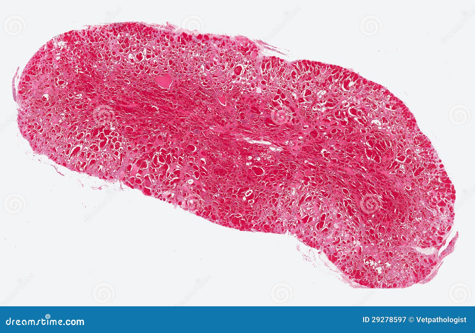 Angioma of the skin stock image. Image of capillary, vessels - 29278597