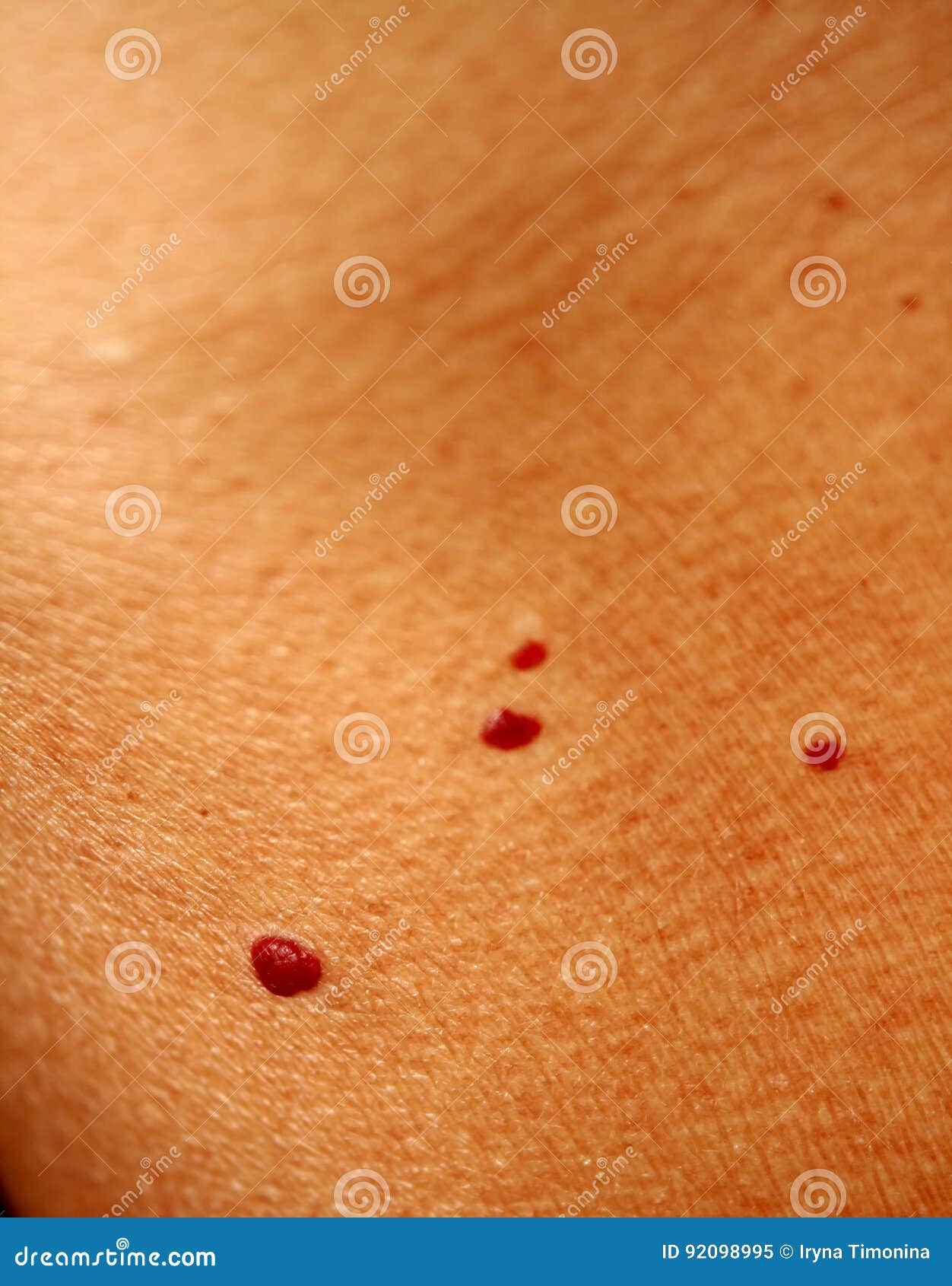 Angioma On The Skin. Red Moles On The Body. Many Birthmarks. Royalty ... Angioma On The Skin. Red Moles On The Body. Many Birthmarks. Royalty ...