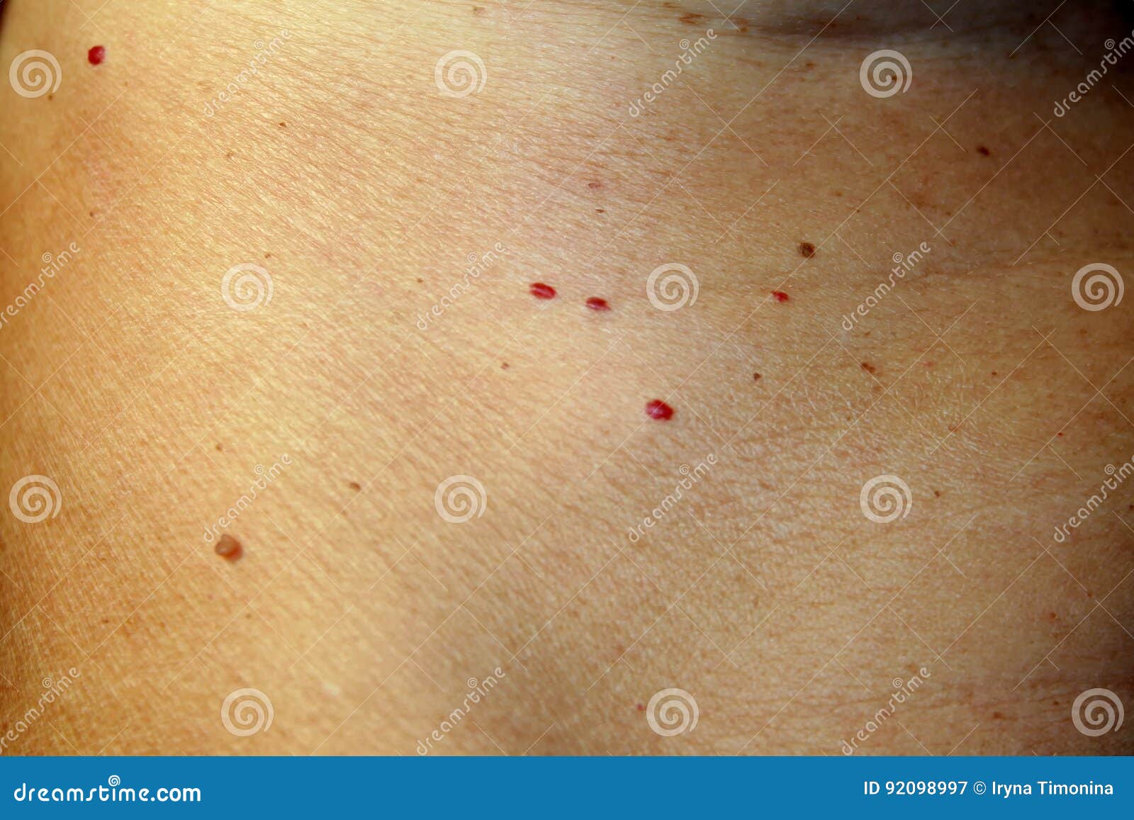 Angioma on the Skin. Red Moles on the Body. Many Birthmarks. Stock ... Angioma on the Skin. Red Moles on the Body. Many Birthmarks. Stock ...